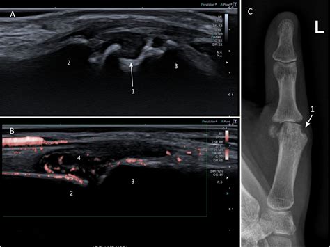 Hand And Wrist Ultrasound London Ultrasound Clinic