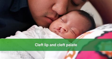 Cleft Lip And Palate Awareness Causes Symptoms And Risk Factors 2024