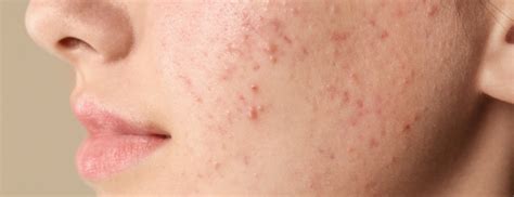 Clogged Pore For 25 Years