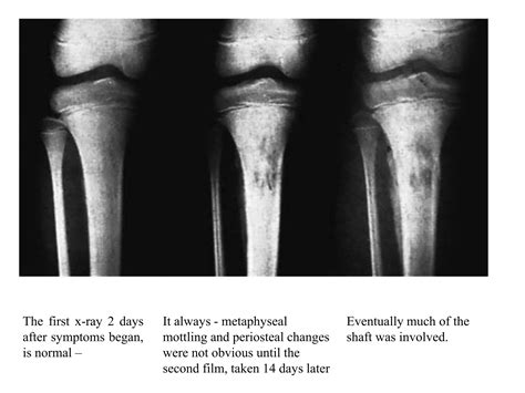 Osteomyelitis Ppt