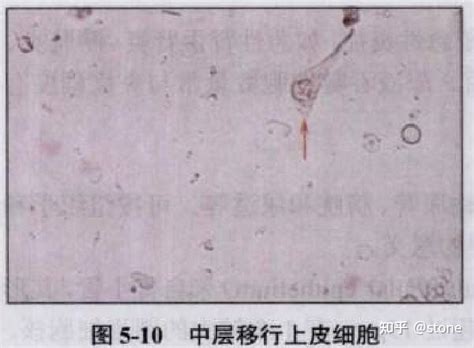 尿液上皮细胞 知乎