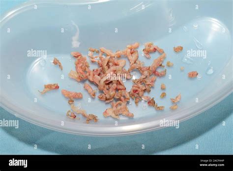 Prostate Diagnostic Surgery Image 8 Of 8 Prostate Tissue Extracted During A Turp