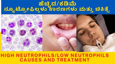 High Low Neutrophil Count Causes Symptoms And Treatment Absolute