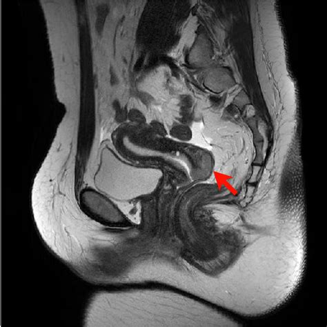 Magnetic Resonance Imaging An Exophytic Mass Is More Prominent In The