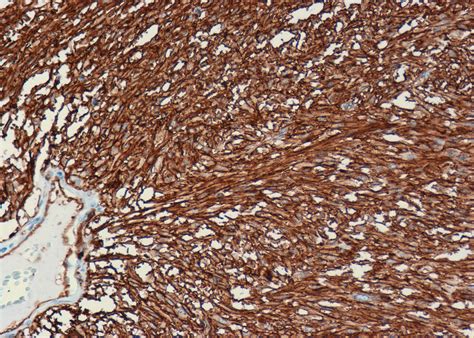 Gist Cd34 Positive Stain Ob 10× Download Scientific Diagram