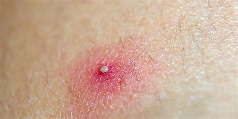 Pustule Acne Treatments Get Rid Of Pustules Effectively Pustules Acne Acne Treatment