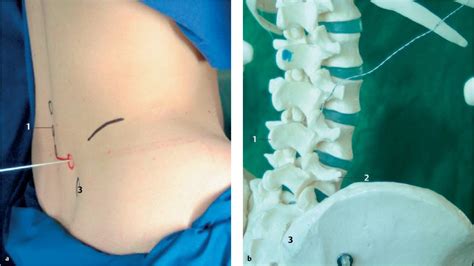 9 Psoas Block Anesthesia Key