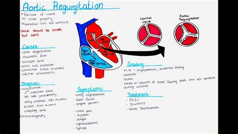 Aortic Regurgitation Causes Symptoms Diagnosis Treatment Grading