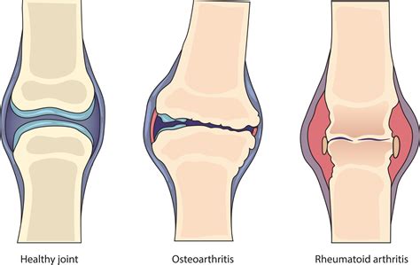 Whats The Difference Osteoarthritis Vs Rheumatoid Arthritis