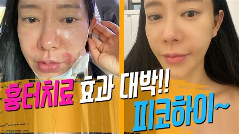 흉터치료 효과 대박 피코하이 레이저 문신도 지워진대~ Youtube