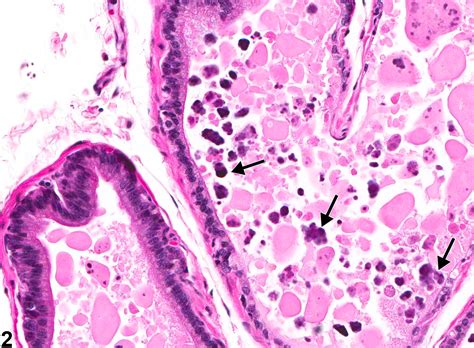 Prostate Acinus Secretory Alteration Concretions Nonneoplastic