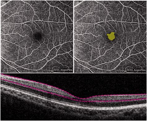 Optical Coherence Tomography Angiography OCTA Images Of Superficial Download Scientific