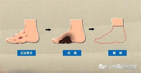 糖尿病足最佳治疗时期——间歇性跛行 知乎