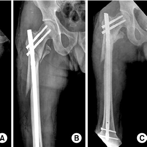 A A 49 Year Old Male Sustained Winquist Hansen Type Iv Ota Ao Type Download Scientific