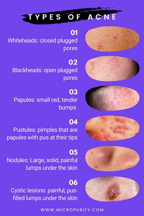 Types Of Acne The Differences Between Your Bumps And Blemishes Artofit