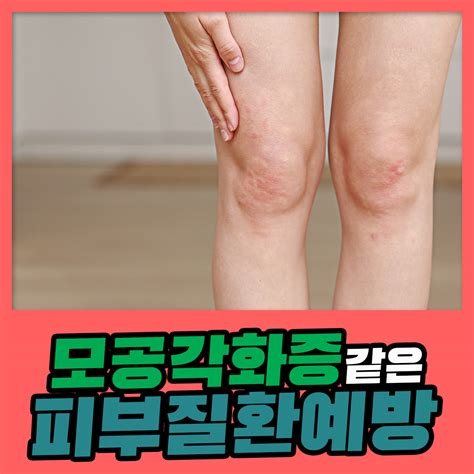 모공각화증 및 어린선과 같은 피부 질환 예방법 건강검진정보 모공각화증 및 어린선과 같은 피부 질환 예방법 건강검진정보