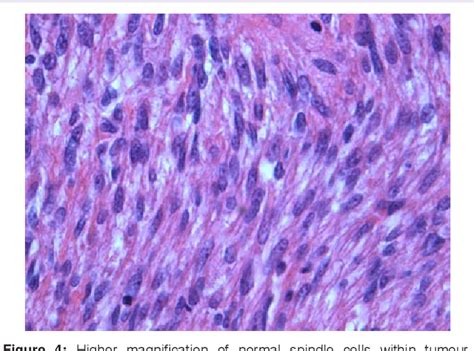 Pdf Epithelioid Angiomyolipoma The Treatment Conundrum Semantic