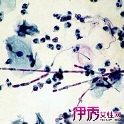 宫颈液基细胞检查图关于宫颈液基细胞检查 列举8大优点以及一些不足 2 伊秀健康 yxlady