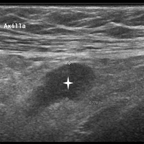 A Left Axillary Lymph Node Excision Revealed Metastatic Poorly