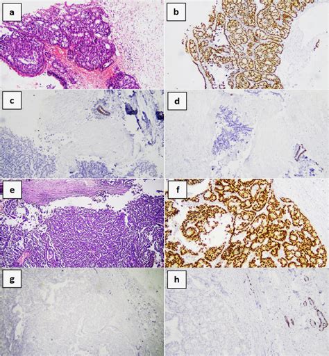 Encysted Papillary Carcinoma Of The Breast Core Needle Biopsy Showing