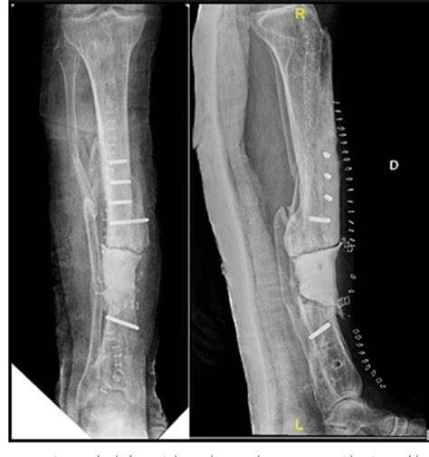 Figure 3 From Treatment Of A Tibial Bone Defect With A Motorized