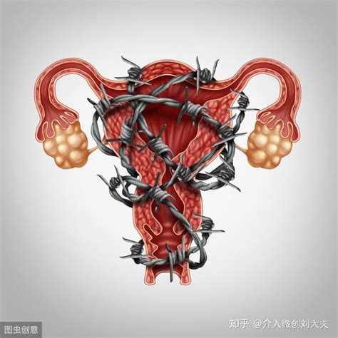 子宫腺肌症的临床分型与治疗方式 知乎