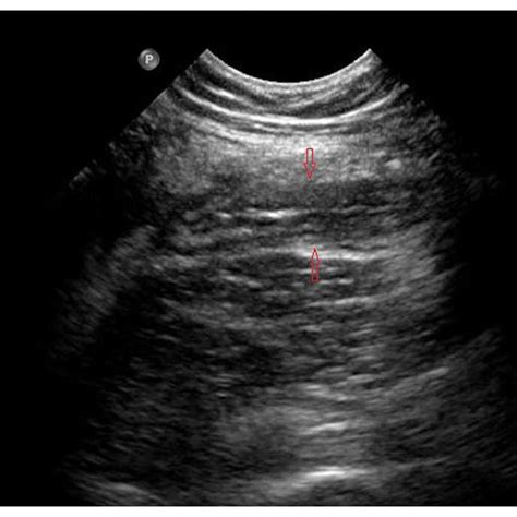 Abdominal Ultrasound Showing Acutely Inflamed Appendix As Indicated By
