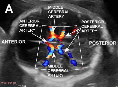 Flow Direction Ultrasound At Sara Swasey Blog