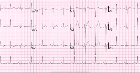 Dr Smiths Ecg Blog Anterior St Elevation Anterior Stemi A Mysterious Case