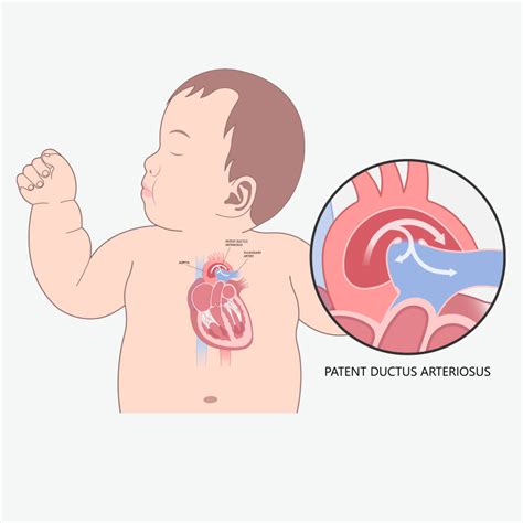 Fetal Ductus Arteriosus Medical Animations Patent Ductus Arteriosus