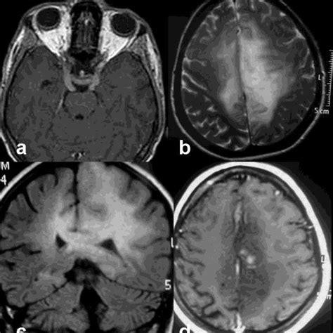 Testicular Lymphoma Patient Testicular Structure Have A Gyriform