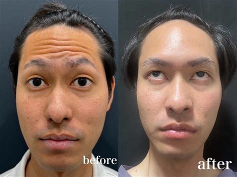 Beautiful Results From Botox Injections On The Forehead Pride Clinic