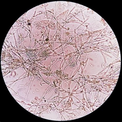 Premium Photo Pseudohyphae And Budding Yeast Cells In Patient Urine Urinary Tract Infections