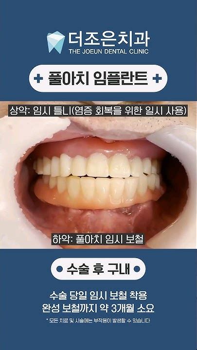 건강한 치아 기능 되찾는 풀아치 임플란트 사례 Youtube
