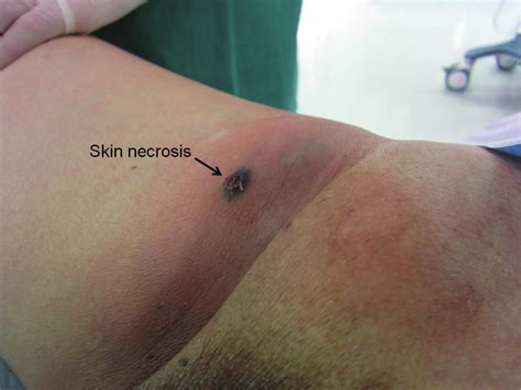 Clinical Picture Shows The Pulsatile Swelling Of The Right Groin With