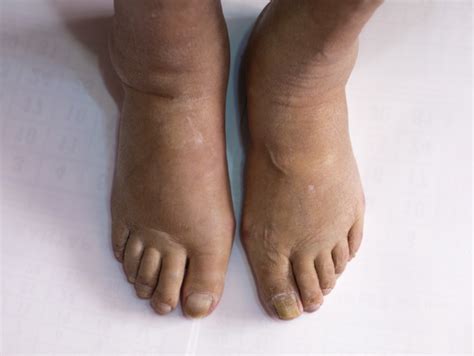 Diabetes Help 4 Friends 6 Warning Signs Of Diabetes In Legs