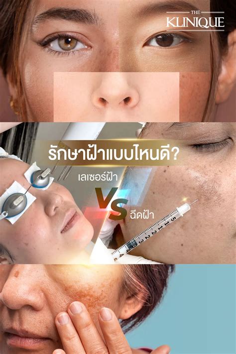 Pico Laser คืออะไร ช่วยรักษาปัญหาผิวประเภทไหนได้บ้าง Theklinique