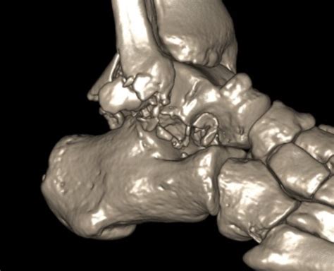 Subtalar Dislocation The Bone School