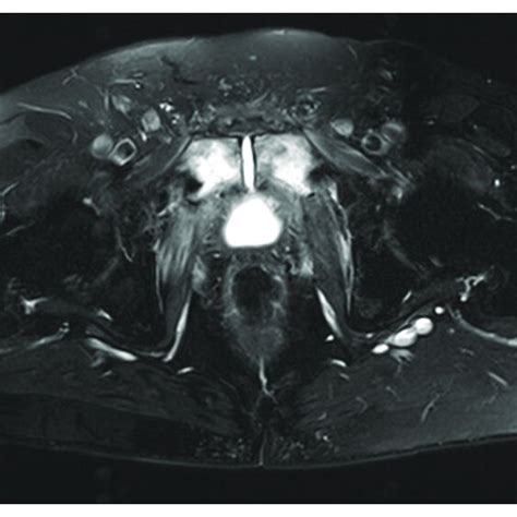 A Pelvic Bone Debridement During Pubectomy For Pubic Osteomyelitis Download Scientific