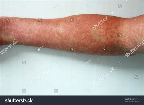 Typical Macular Rash Forearm This Could Foto Stock 24223534 Shutterstock