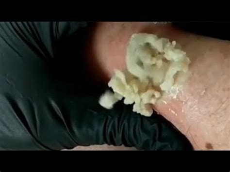 CRAZY PIMPLES POPPING COMPILATION Best CYST REVEAL Of Week PART YouTube