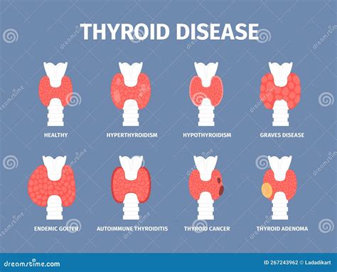 Thyroid Gland Various Diseases Goiter And Hyperthyroid Inflammation Trachea Icons Stock Vector