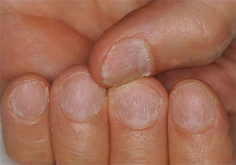 Alopecia Areata Nails