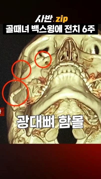 골프 연습 하려다퍽 전치6주 사건반장 Shorts 골프스윙 골절 급발진사고 Youtube