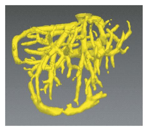 The Liver Vessel Segmented By Using The Improved Fuzzy Connectedness Download Scientific