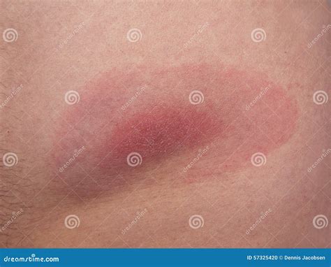 Lyme Disease Erythema Migrans Stock Images By Megapixl