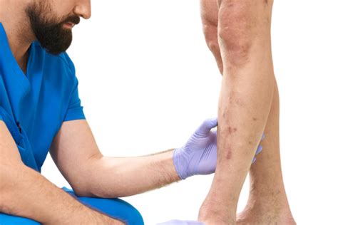 Spider Veins Integrative Cardiology