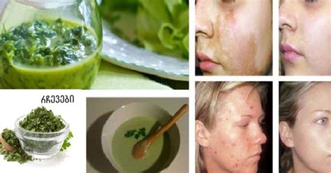 დაემშვიდობეთ მუქ ლაქებს და ჭორფლებს ეს ინგრედიენტი მოგაშორებთ მათ