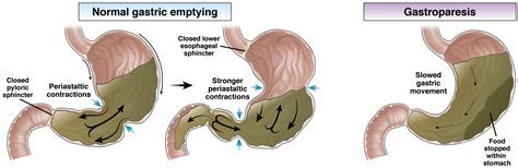 Gastroparesis Aga Gi Patient Center