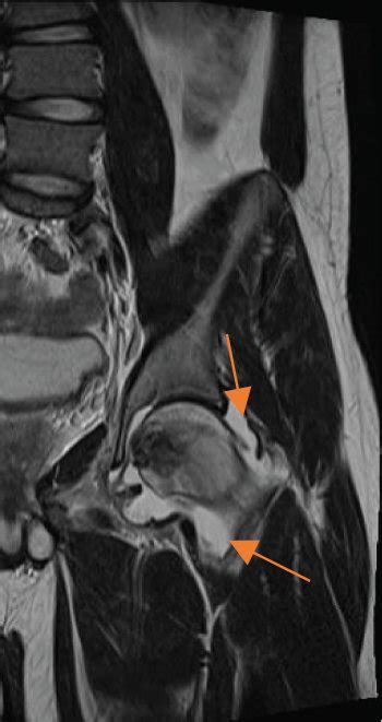 T2 Mri Views Of The Left Hip Coronal View A And Axial View B Of